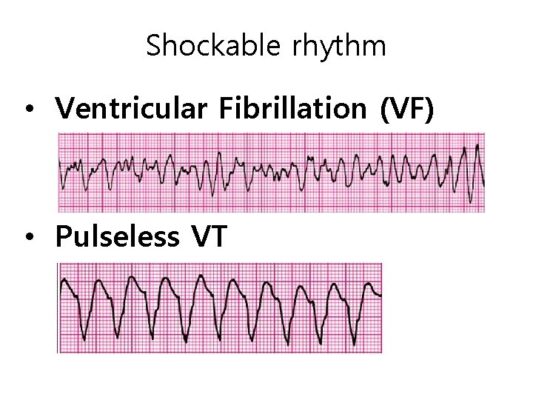 Shockable vs. Non-Shockable Rhythms: AED Use Explained